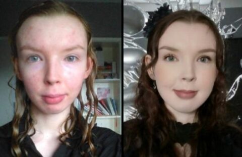 Mewing Appliance - A Device to Improve Your Facial Appearance