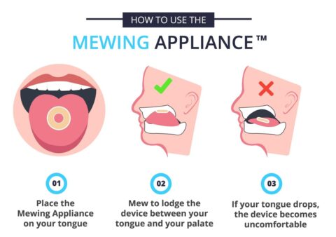 Mewing Appliance - A Device to Improve Your Facial Appearance