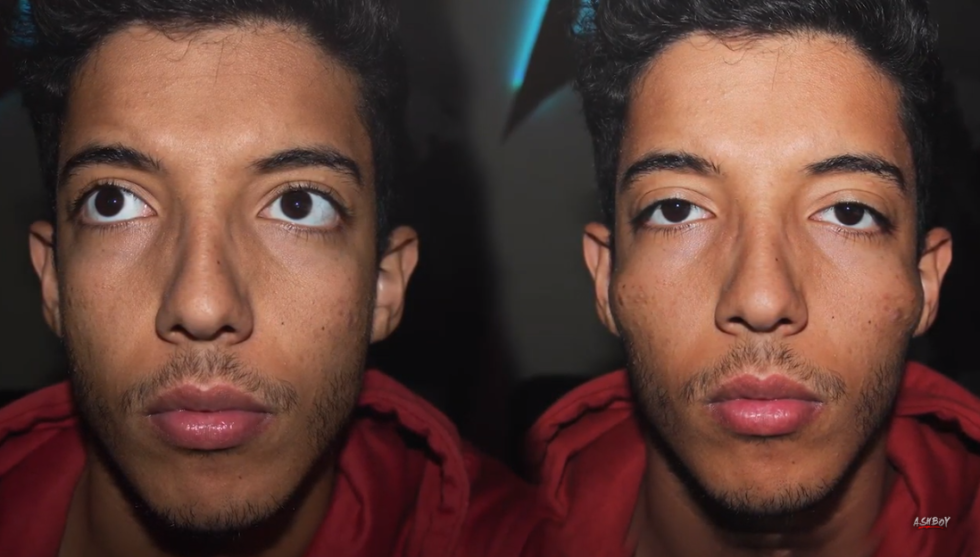 Bone smashing - Mewing Appliance